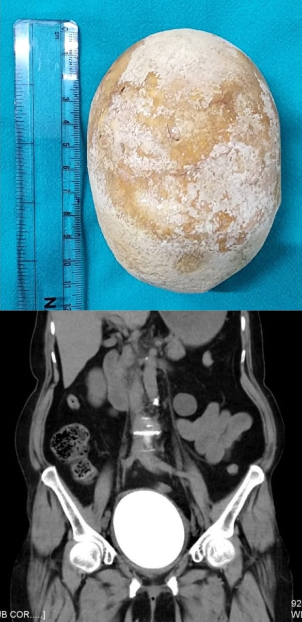 Manipal: Urologists of Kasturba Hospital remove large bladder stone ...